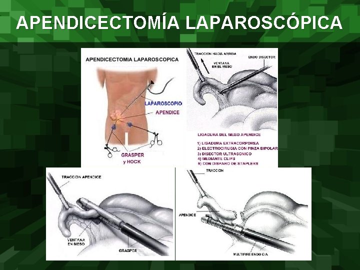 APENDICITIS AGUDA ROMMY CEDEO MENDOZA APNDICE NORMAL Tambin