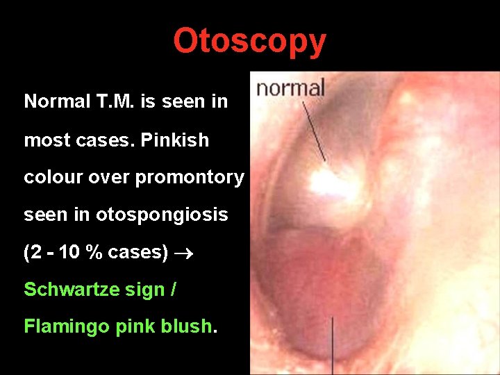 Otosclerosis Dr Vishal Sharma Definition Hereditary disease of