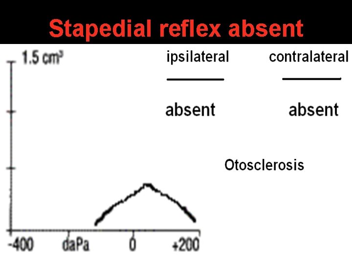 Otosclerosis Dr Vishal Sharma Definition Hereditary disease of