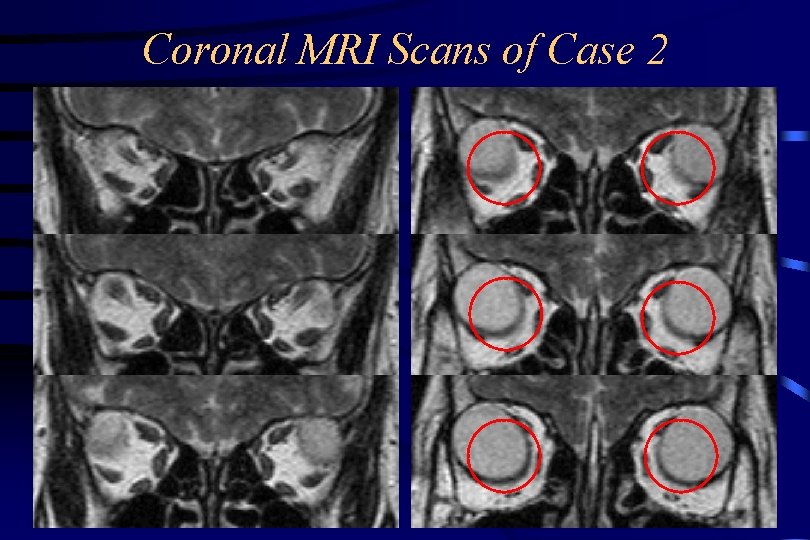 Treatment of Progressive Esotropia Caused By High Myopia