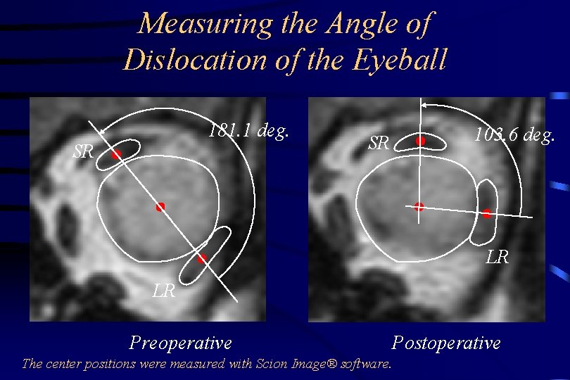 Treatment of Progressive Esotropia Caused By High Myopia