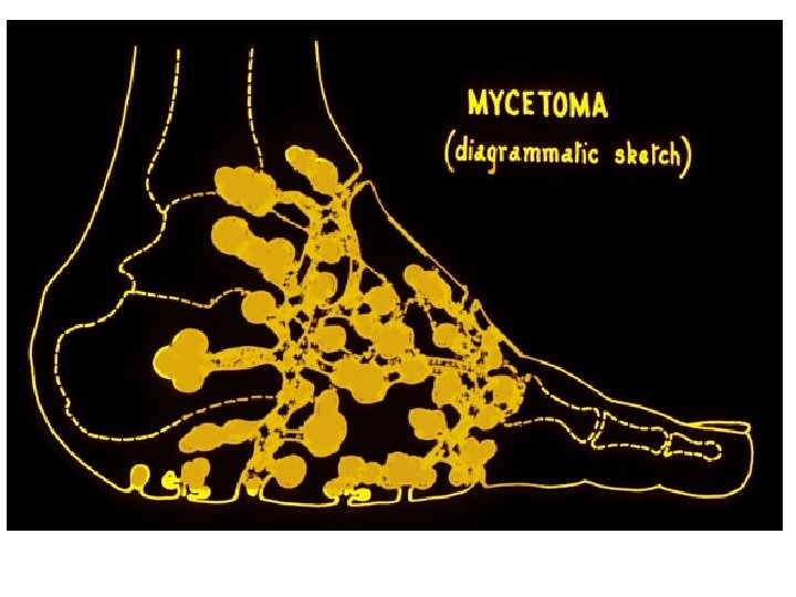 Subcutaneous Mycoses These are caused by fungi that
