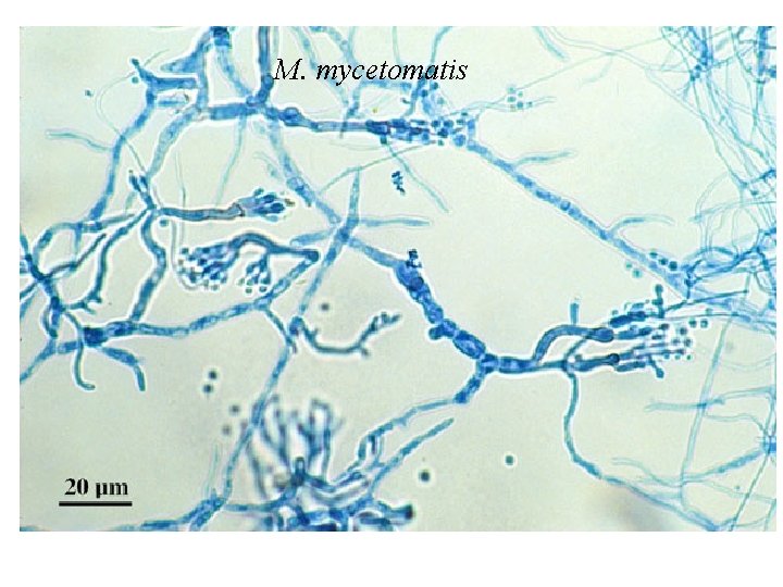 Subcutaneous Mycoses These are caused by fungi that