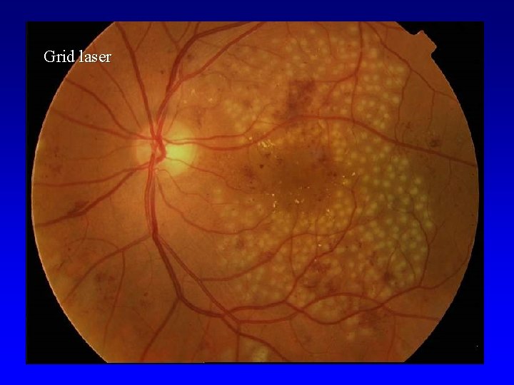 Diabetic retinopathy diagnostics therapy classification Diabetes ...