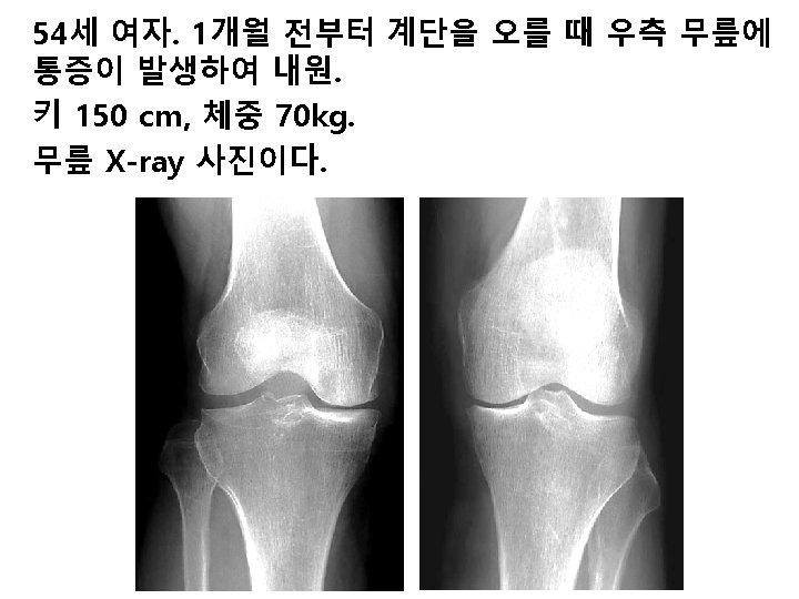 Knee OA ACR criteria for knee OA Clinical