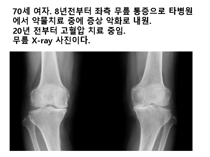 Knee OA ACR criteria for knee OA Clinical