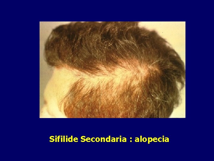 SIFILIDE AGENTE EZIOLOGICO Treponema pallidum Malattia a trasmissione