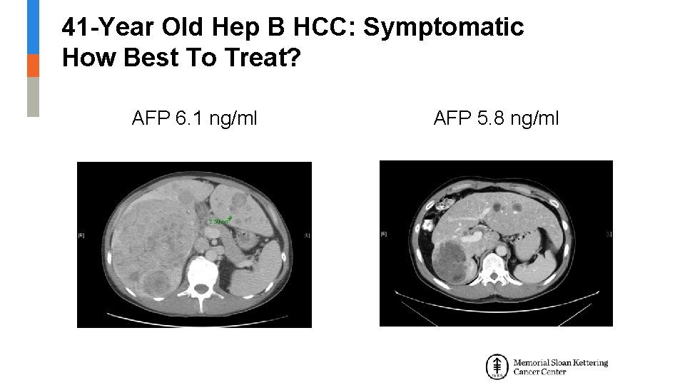Module 2 Hepatocellular Carcinoma and Pancreatic Cancer Jessica
