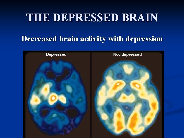 DEPRESSION Its Symptoms Causes and Treatment Presentation by