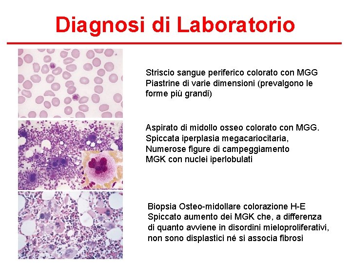Disordini delle Piastrine Trombocitopenia Porpora Trombotica ...