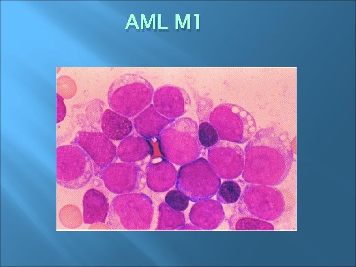 PEMERIKSAAN LABORATORIUM PADA LEUKEMIA AKUT BY dr RISMAWATI