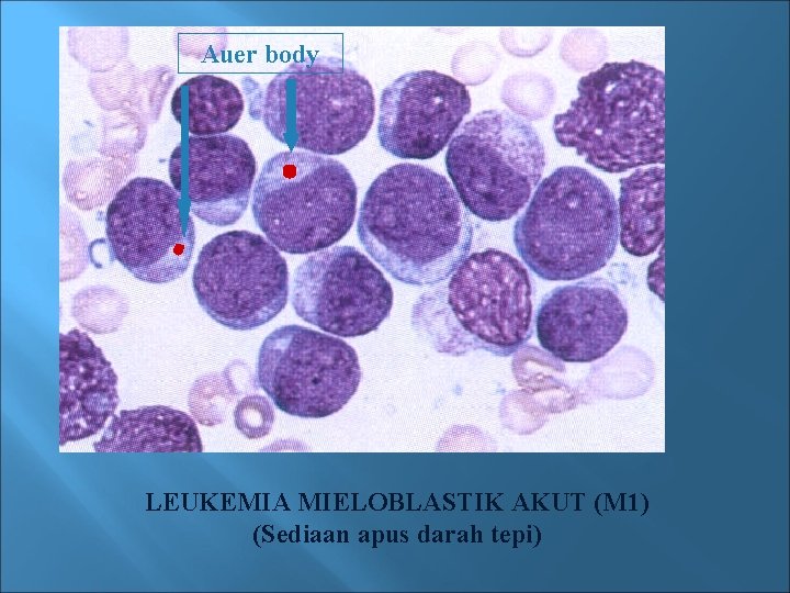 PEMERIKSAAN LABORATORIUM PADA LEUKEMIA AKUT BY dr RISMAWATI