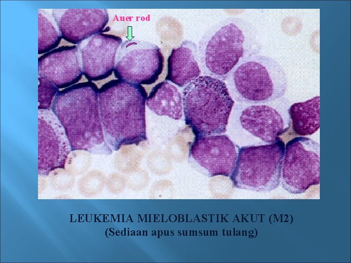 PEMERIKSAAN LABORATORIUM PADA LEUKEMIA AKUT BY dr RISMAWATI