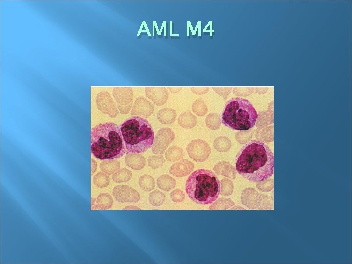 PEMERIKSAAN LABORATORIUM PADA LEUKEMIA AKUT BY dr RISMAWATI