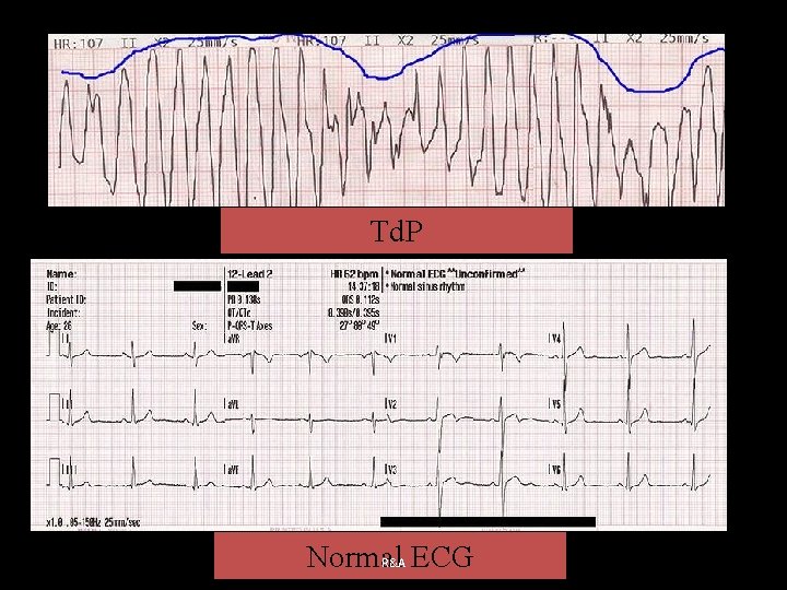 Antipsychotics and QTc Prolongation Rocco de Filippis MD