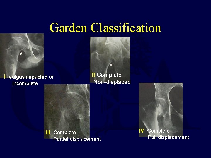 Femoral Neck Fractures James C Krieg MD Original
