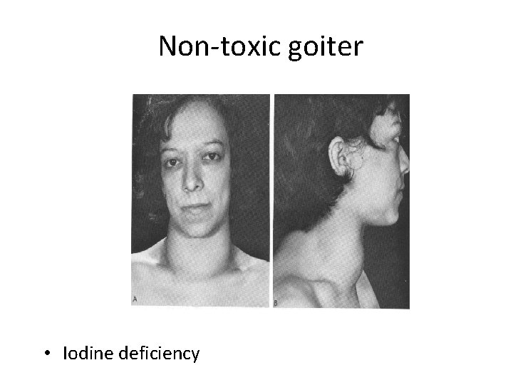 THYROID DYSFUNCTION Graves disease 10 Autoimmune activating ABs