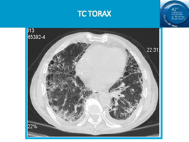 PRESENTACION DE CASO CLINICO N 225 Seccin Enfermedades