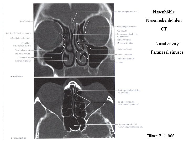 Nasenhhle Nasennebenhhlen CT Nasal cavity Paranasal sinuses Tillman
