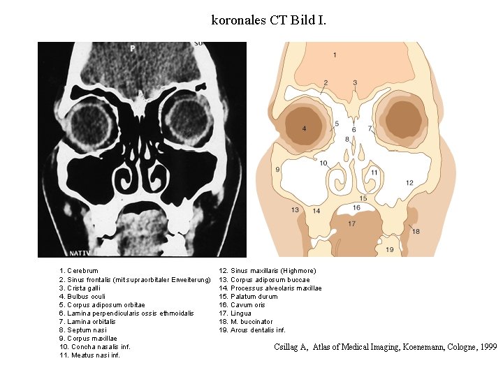 Nasenhhle Nasennebenhhlen CT Nasal cavity Paranasal sinuses Tillman