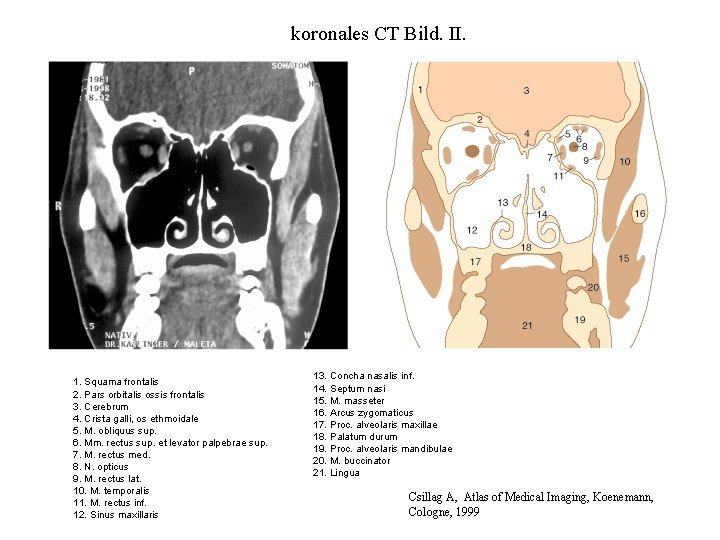 Nasenhhle Nasennebenhhlen CT Nasal cavity Paranasal sinuses Tillman