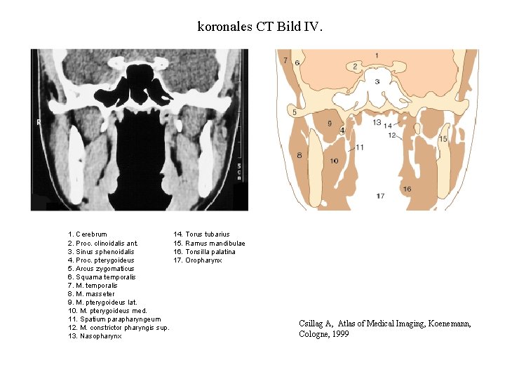 Nasenhhle Nasennebenhhlen CT Nasal cavity Paranasal sinuses Tillman