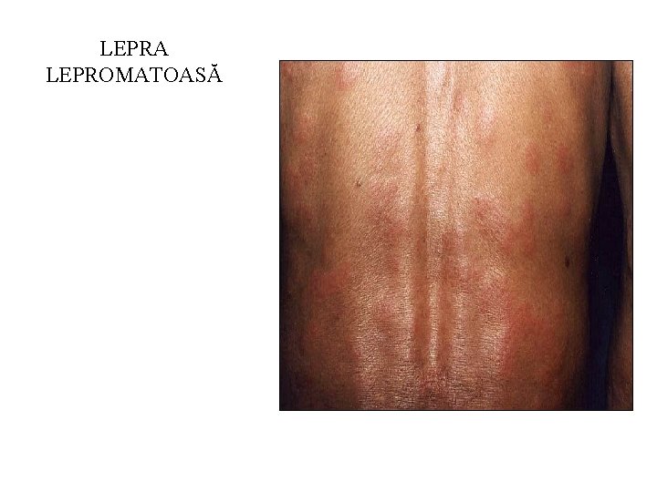 LEPRA BOALA HANZEN DEFINIIE Lepra este o maladie