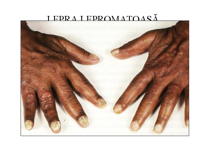 LEPRA BOALA HANZEN DEFINIIE Lepra este o maladie