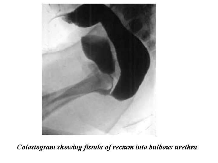 Anorectal Malformation Imperforate Anus Dr Saqib Ismail Assistant