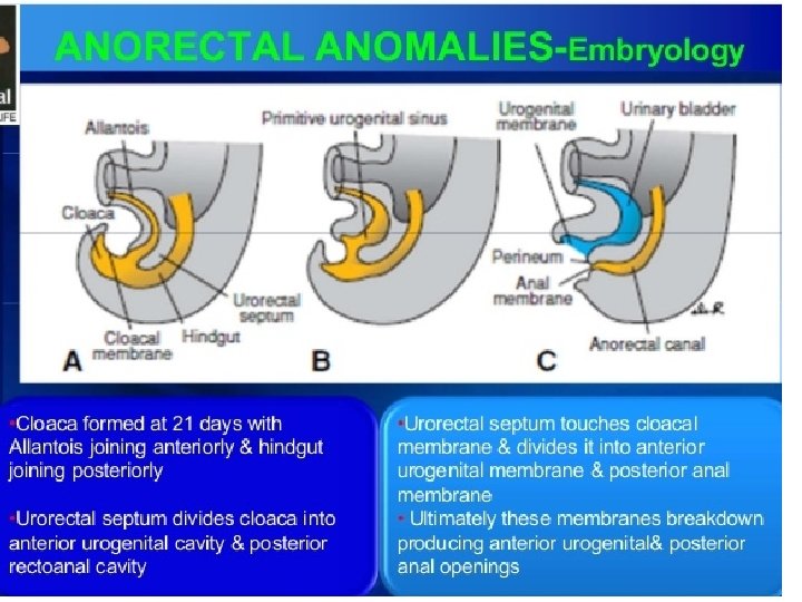 Anorectal Malformation Imperforate Anus Dr Saqib Ismail Assistant