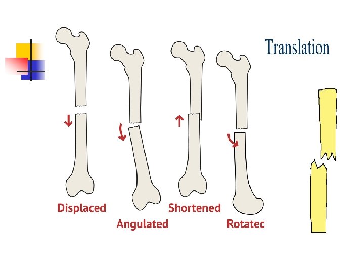 Principles of fractures Dr Mohammad Abu Hilal Ass