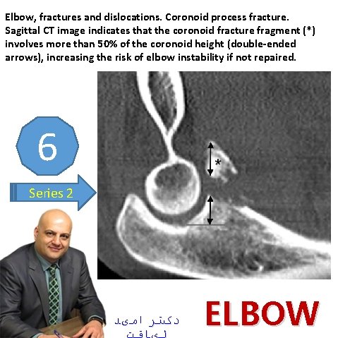 Elbow fractures and dislocations Comminuted extraarticular fracture of