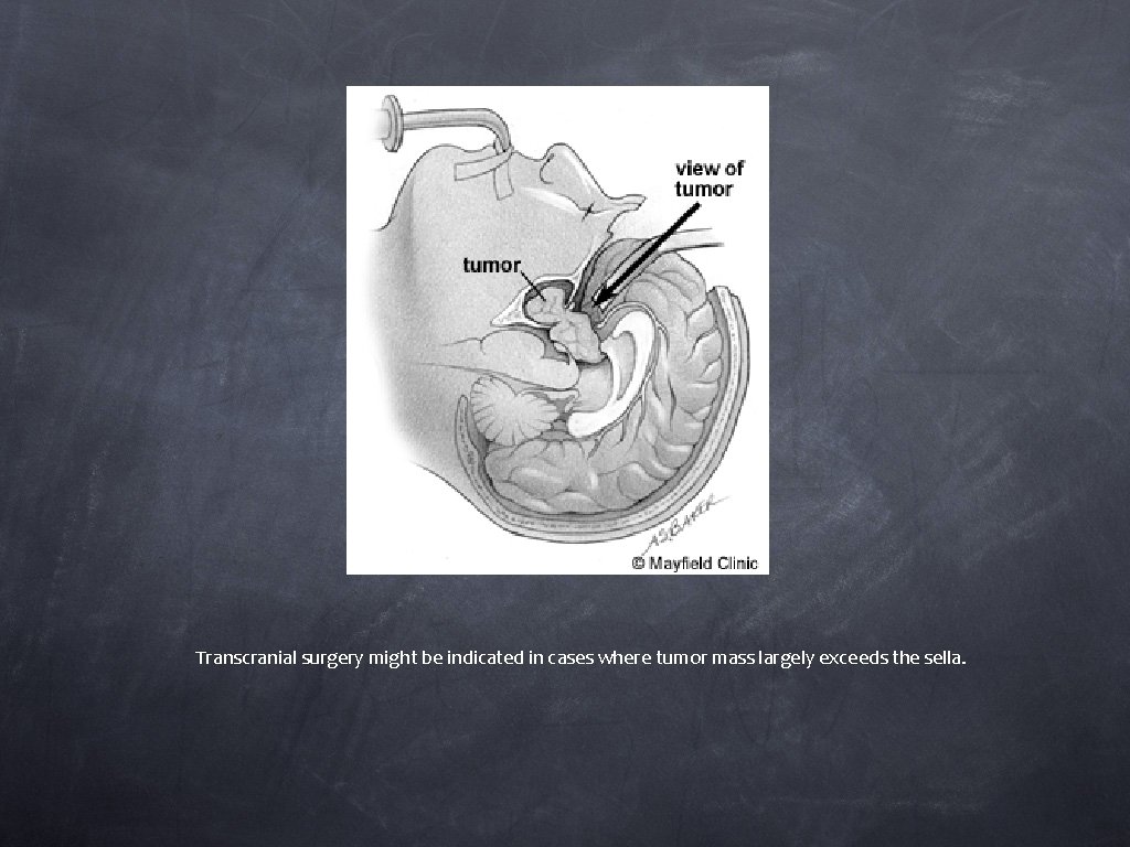 Case Report Transsphenoidal approaches in pituitary adenomas Jesper