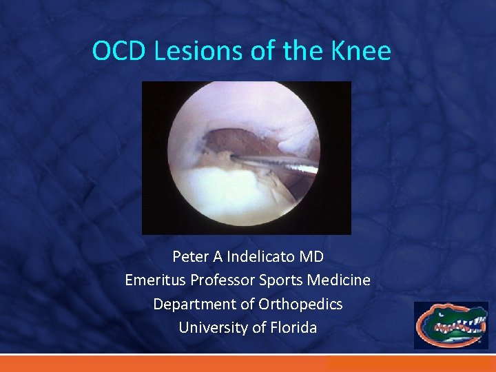 OCD Lesions of the Knee Peter A Indelicato