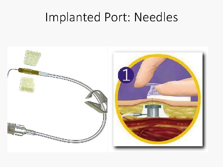 Central Lines Overview and Management Brunner 13 th