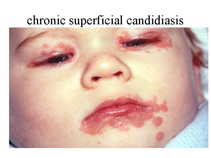 CANDIDA Spp Classification Mycoses are classified according to