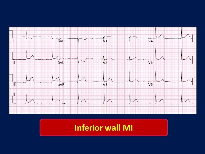 Acute coronary syndrome Keerapa phusunti MD Chokchai hospital