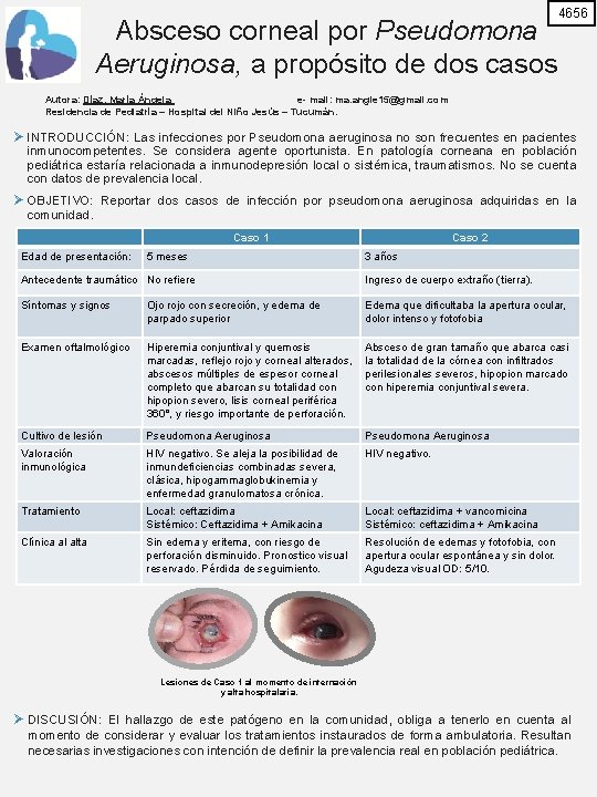 Absceso corneal por Pseudomona Aeruginosa a propsito de