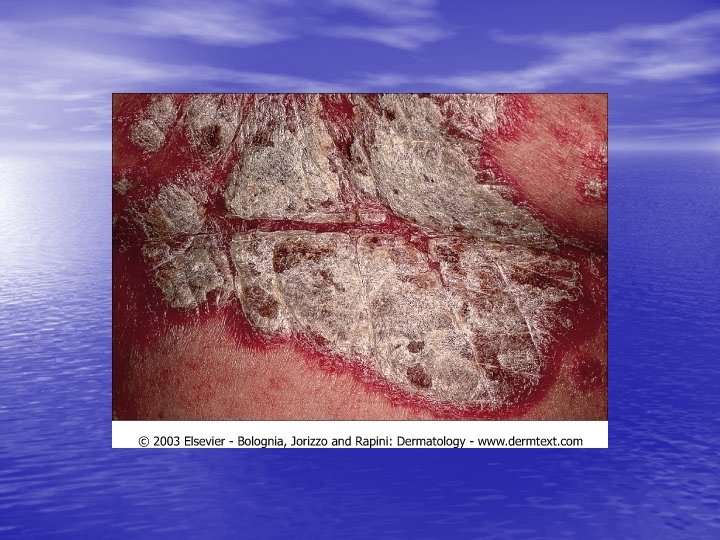 PAPULOSQUAMOUS DISEASES Psoriasis Lichen planus Lichen nitidus Pityriasis