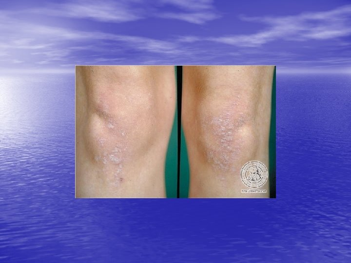 PAPULOSQUAMOUS DISEASES Psoriasis Lichen planus Lichen nitidus Pityriasis