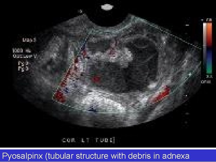 Pelvic Inflammatory Disease A Condition Requiring Closer Attention