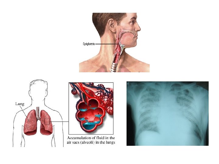 Laryngeal Spasm and Negative Pressure Pulmonary Edema Dr