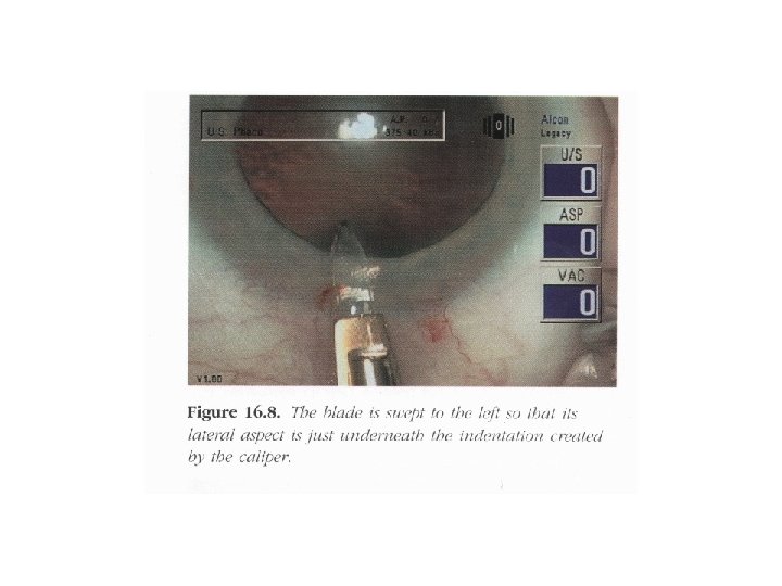 WOUND CLOSURE VECTOR ANALYSIS PHACO VERTICALLY APPLIED IOP