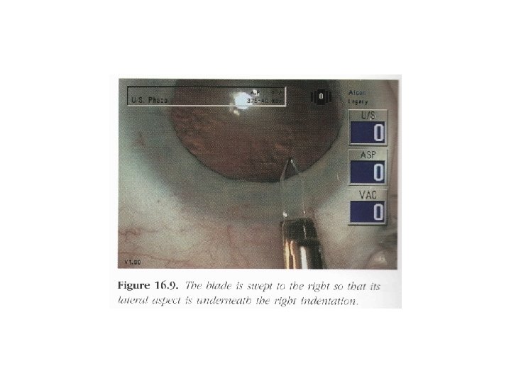 WOUND CLOSURE VECTOR ANALYSIS PHACO VERTICALLY APPLIED IOP