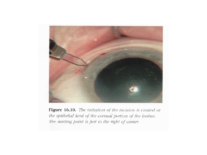 WOUND CLOSURE VECTOR ANALYSIS PHACO VERTICALLY APPLIED IOP