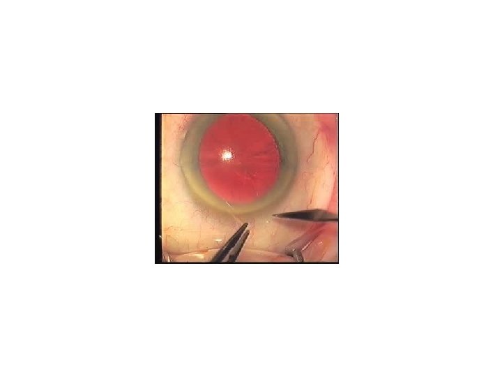 WOUND CLOSURE VECTOR ANALYSIS PHACO VERTICALLY APPLIED IOP
