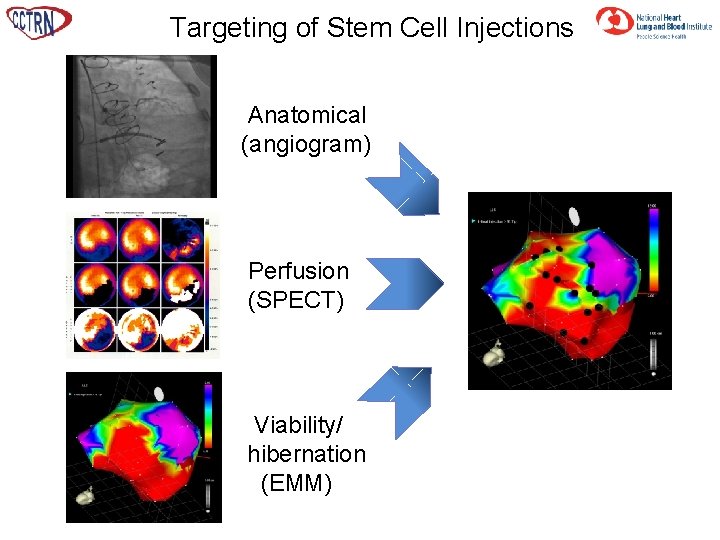 Effect of Transendocardial Delivery of Autologous Bone Marrow