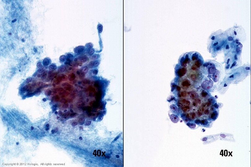 Thin Prep Pap Test Diagnostic Challenges and Differential