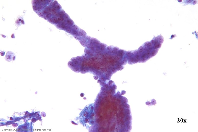 Thin Prep Pap Test Diagnostic Challenges and Differential