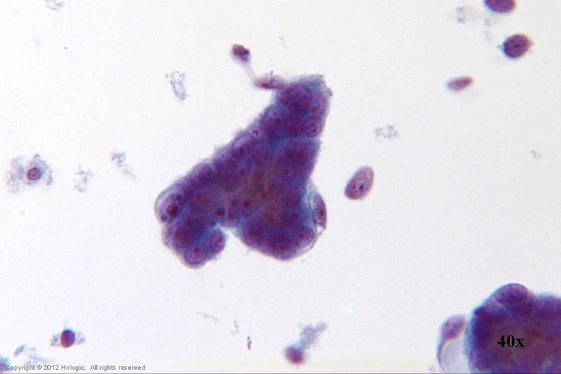 Thin Prep Pap Test Diagnostic Challenges and Differential